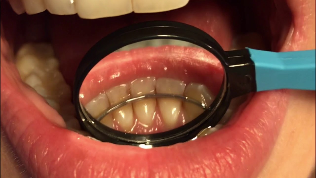 How to Floss a Retainer - YouTube