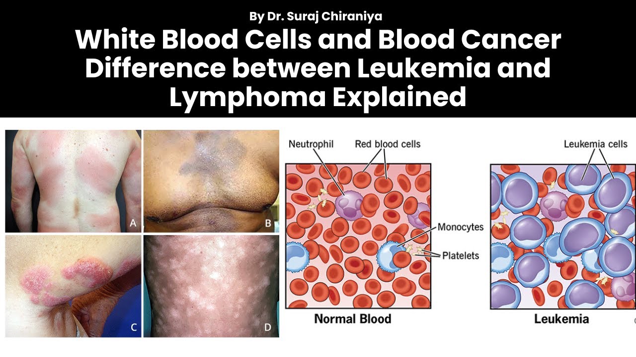 White Blood Cells and Blood Cancer | Difference between Leukemia and ...