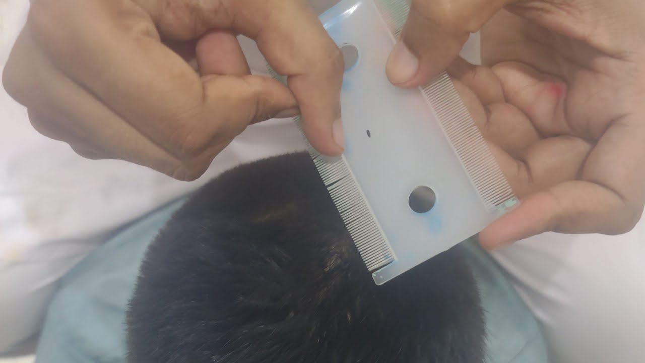 ASMR Lice Comb Checking& Scalp Examination - YouTube