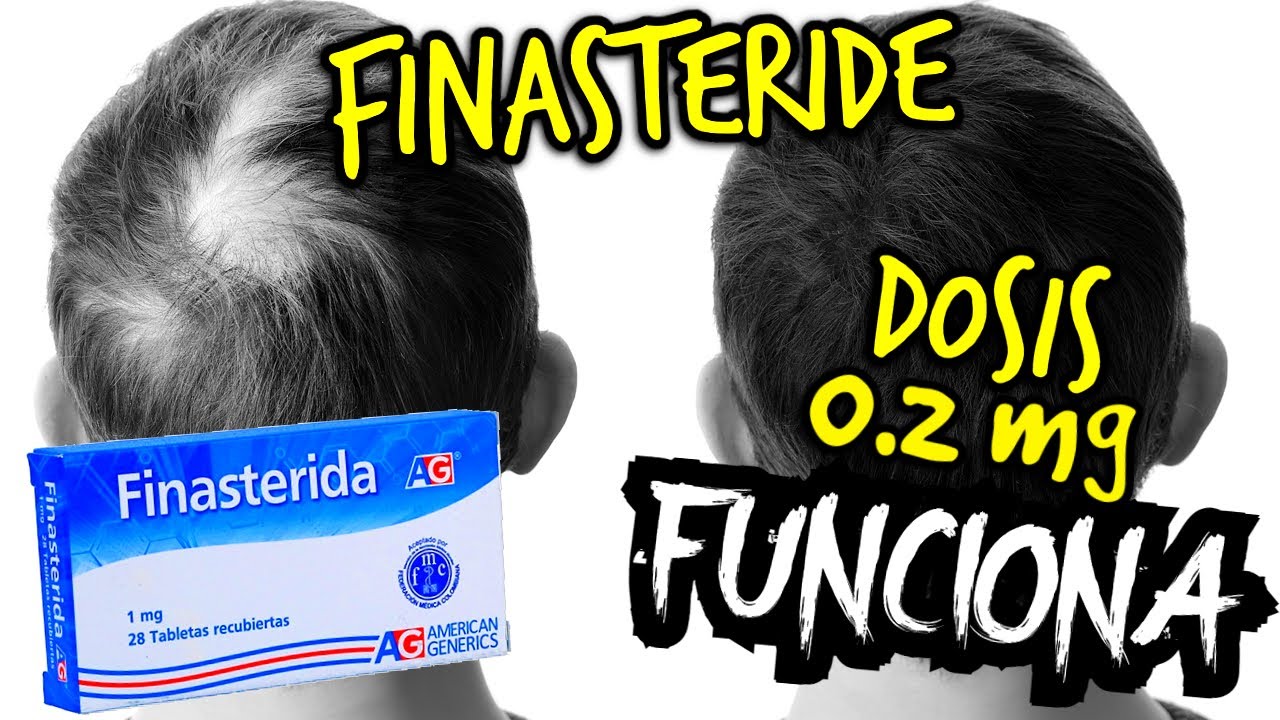 Finasteride DOSIS 1mg se puede REDUCIR a 0.2 mg | Tratamiento CALVICIE ...