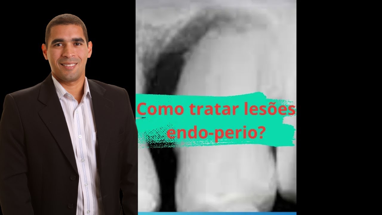 Como tratar lesão endo perio ? @dr.alexguedes - YouTube