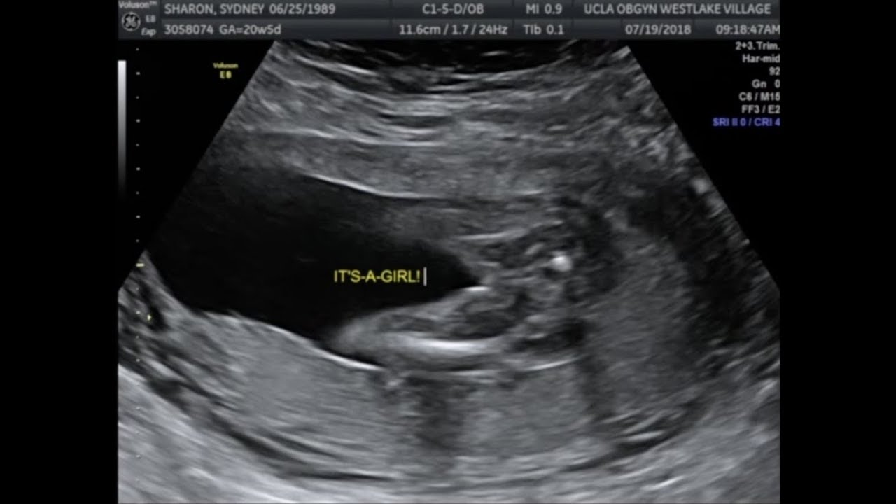 Baby Girl 20 Week Anatomy Scan Of Our IUI Baby Via Sperm Donor SPERM baby-girl-20-week-anatomy-scan-of-our-iui-baby-via-sperm-donor-sperm