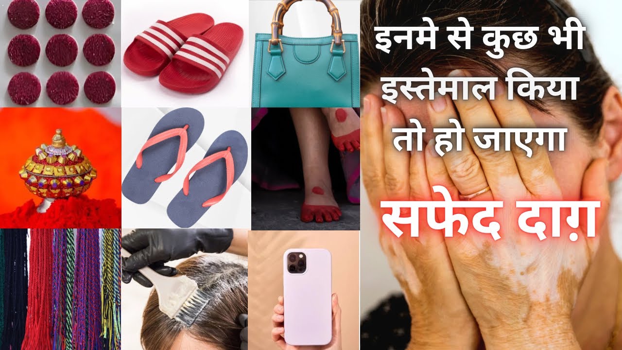 chemical leucoderma | Bindi leucoderma | PPD | Phenols | Azo dyes | Dr ...
