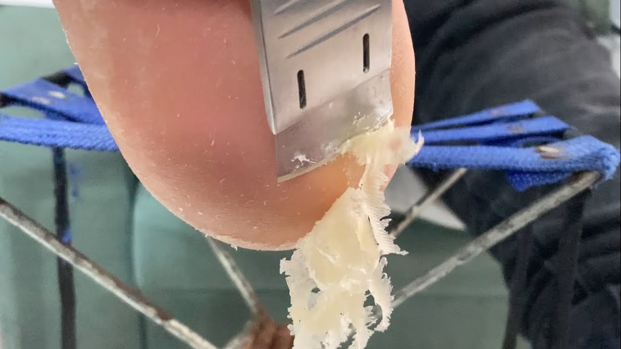 Extreme Foot Callus Removal Challenge | Expert Technique Unveiled - YouTube