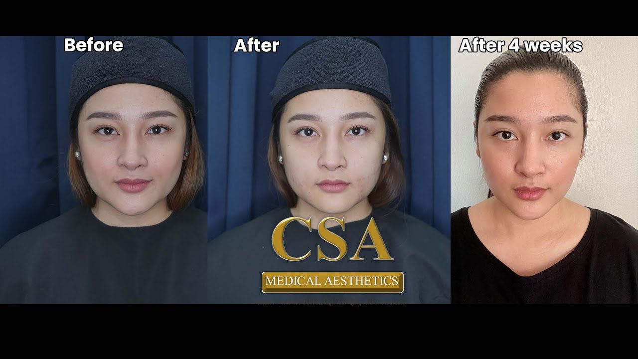 FACE CONTOUR THREADS - YouTube