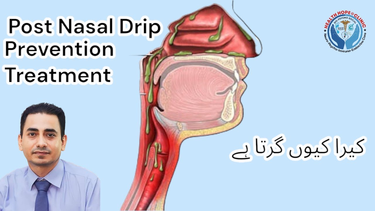 "Understanding and Treating Post Nasal Drip: Effective Remedies and ...