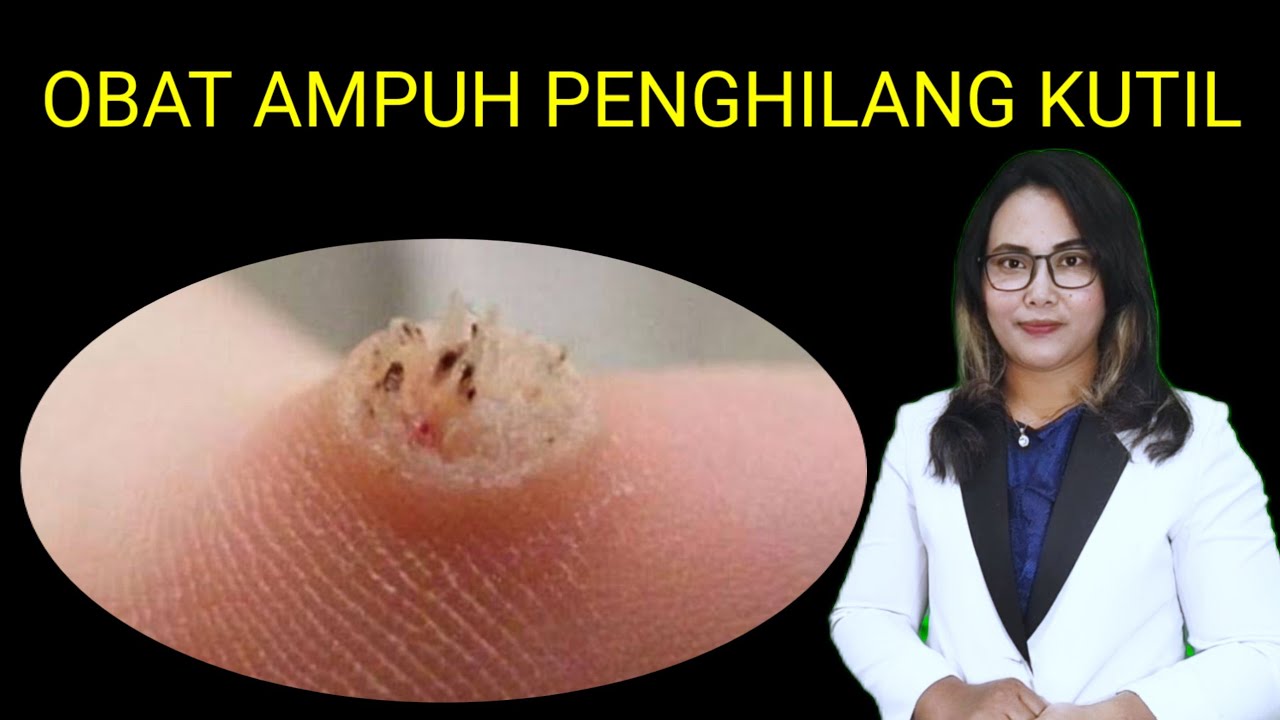 Kutil Hilang Dengan Obat Ini || Gejala, Penyebab, dan Pengobatan ...