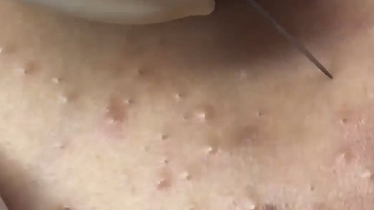 LARGE Blackheads Removal - Satisfying Blackhead 2019 (Part 01) - YouTube