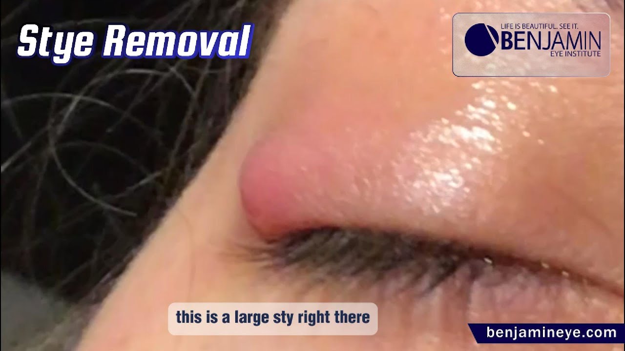 Large stye on eyelid removal - YouTube