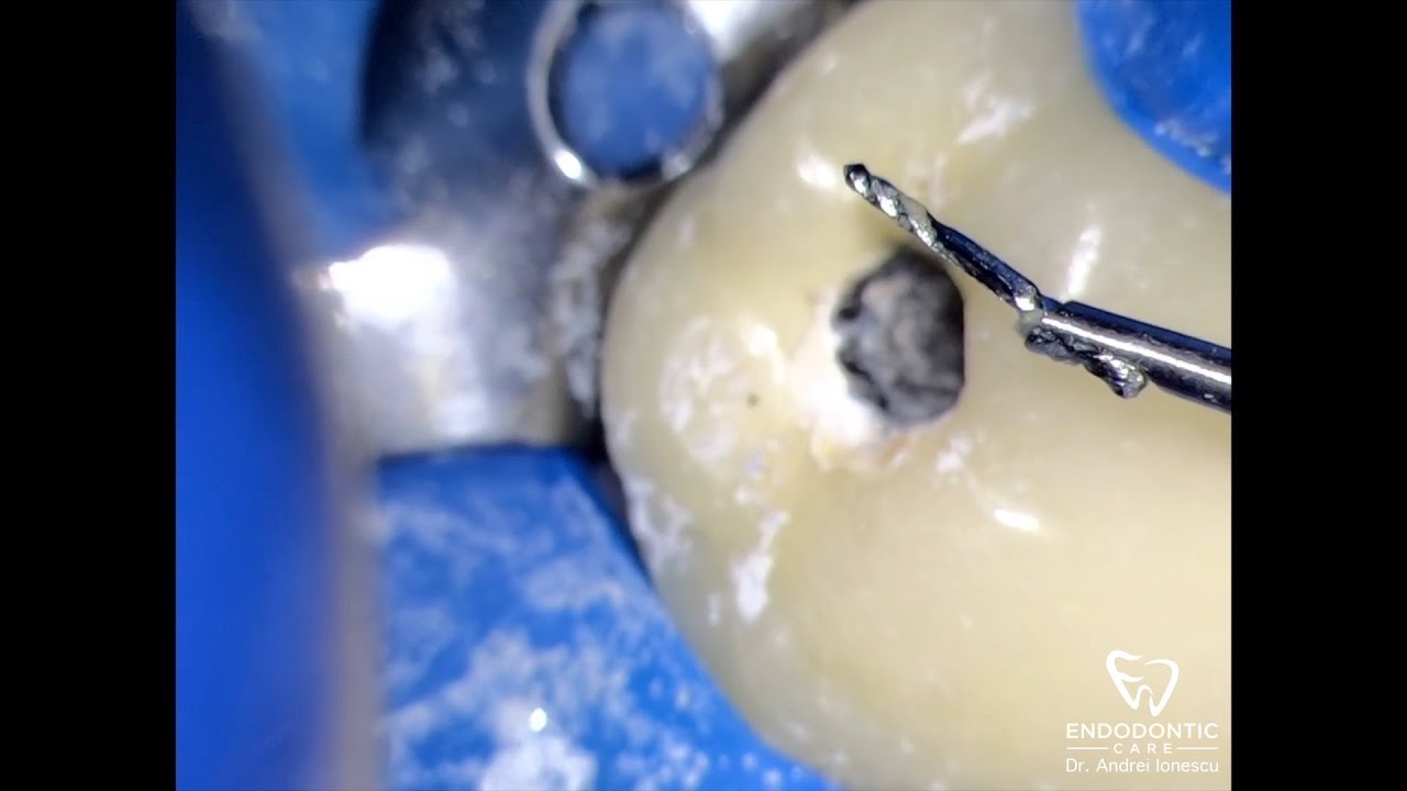 Broken file removal using the IRS system. Dr. Andrei Ionescu - YouTube