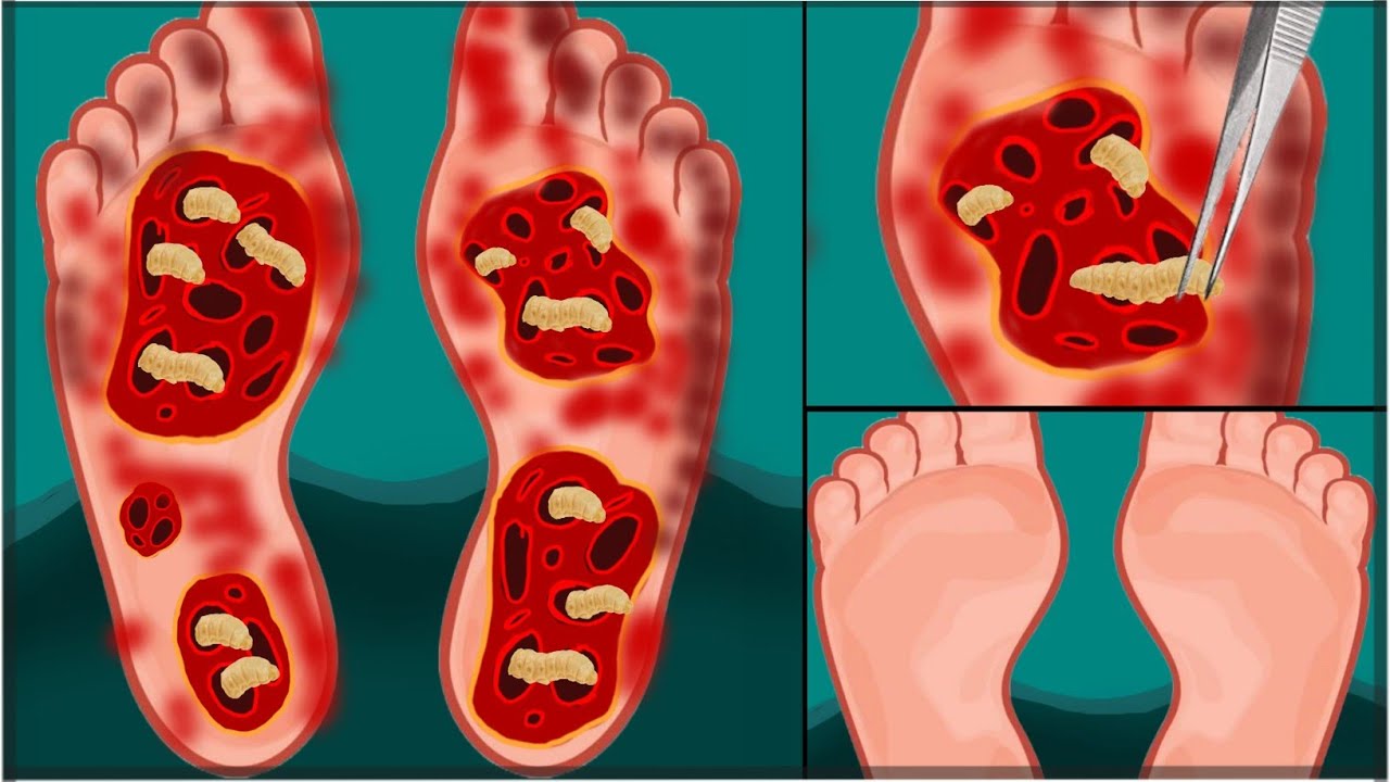 ASMR Remove fungal Infection between toes//Foot Treatment//Beauty ASMR ...