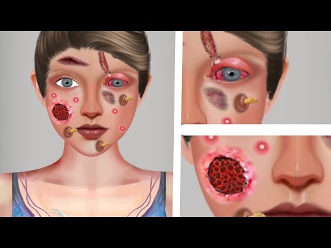 Acne and damaged skin treatment | fungul infection treatment asmr ...