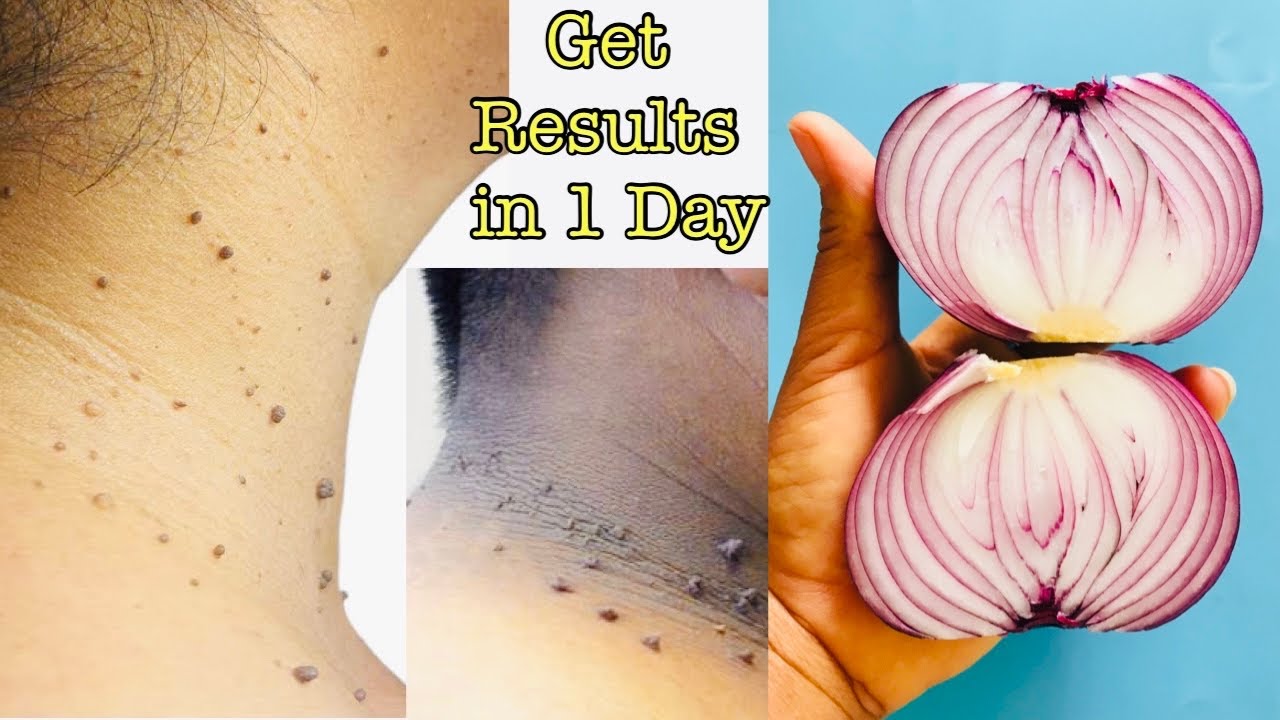 In 1 Night Only, Remove Skin tags at home | How to get rid of skin tags ...