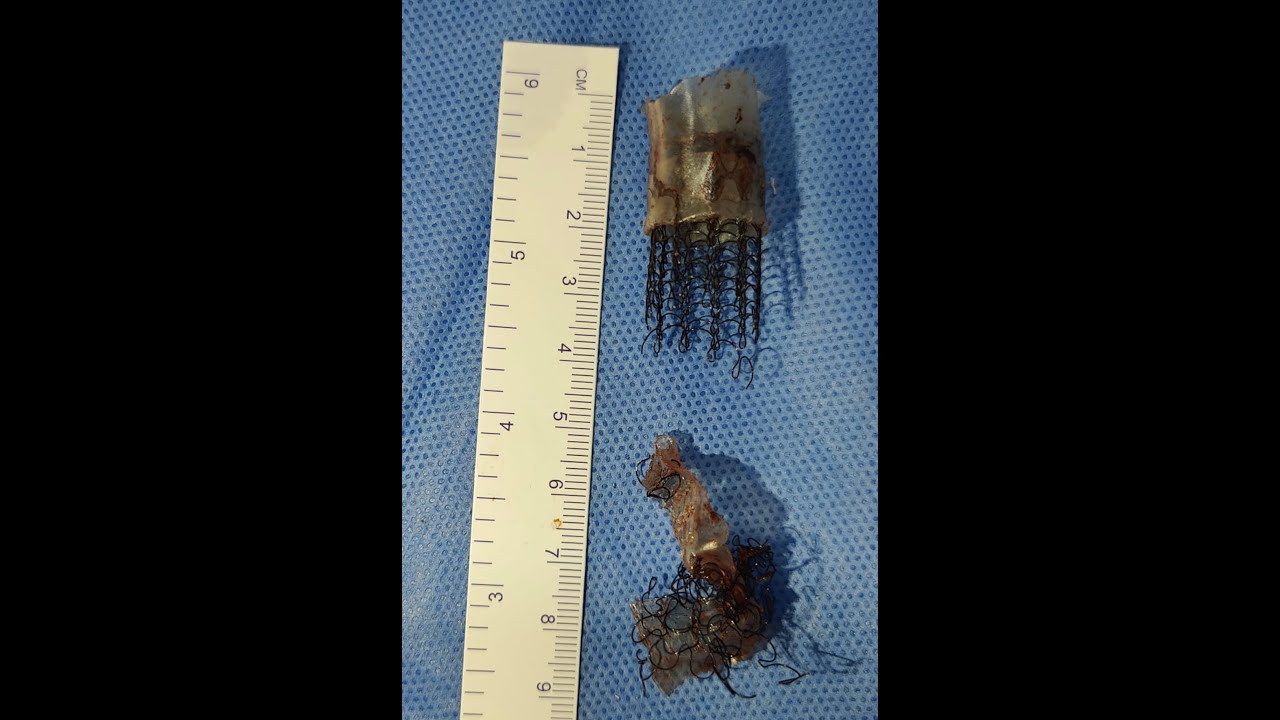 COMPLICATED AIRWAY STENT REMOVAL - YouTube