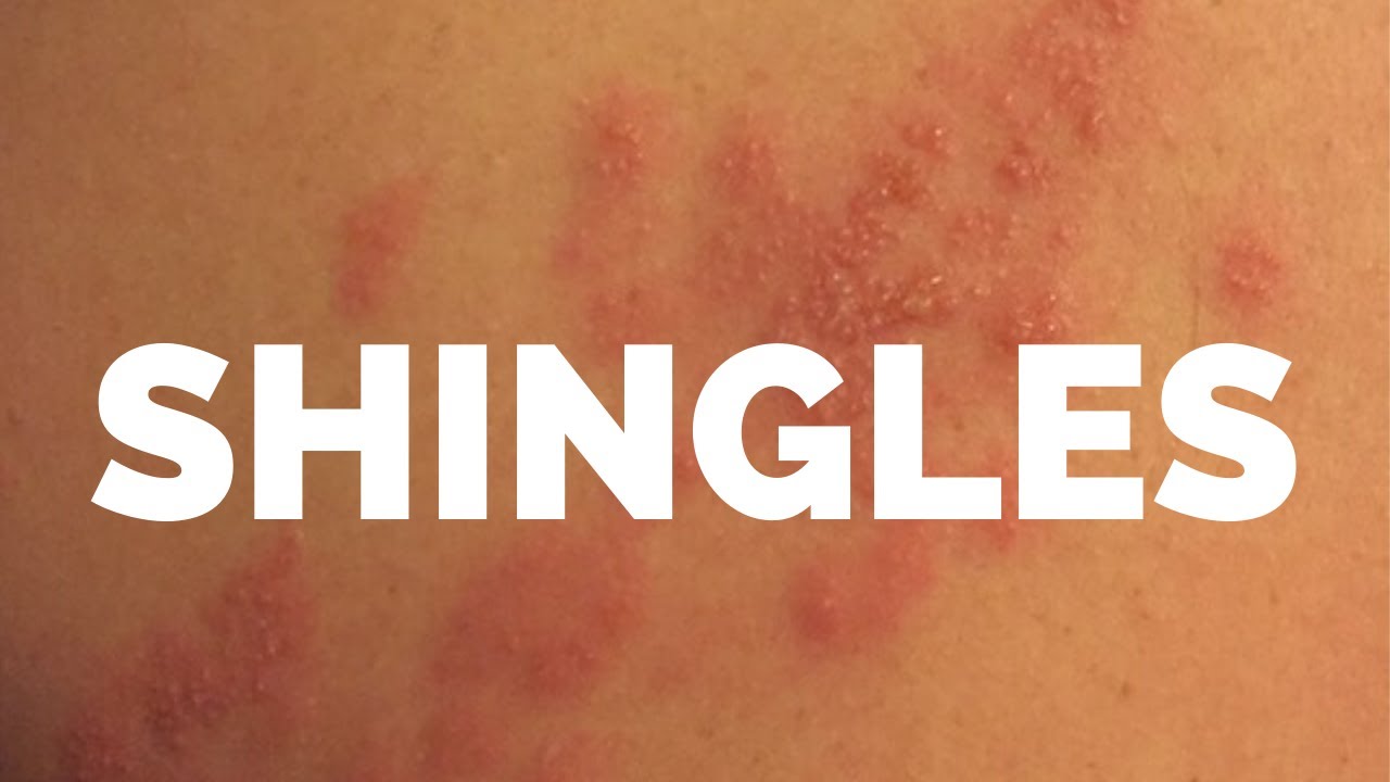 SHINGLES - My Personal Experience and how I healed my SHINGLES - YouTube