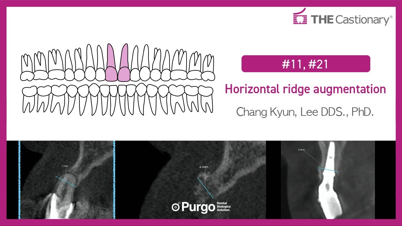 [#11, 21] Horizontal ridge augmentation - YouTube