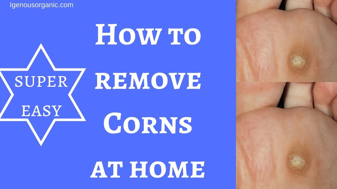 How to remove Corns at home!Simple Remedies - YouTube