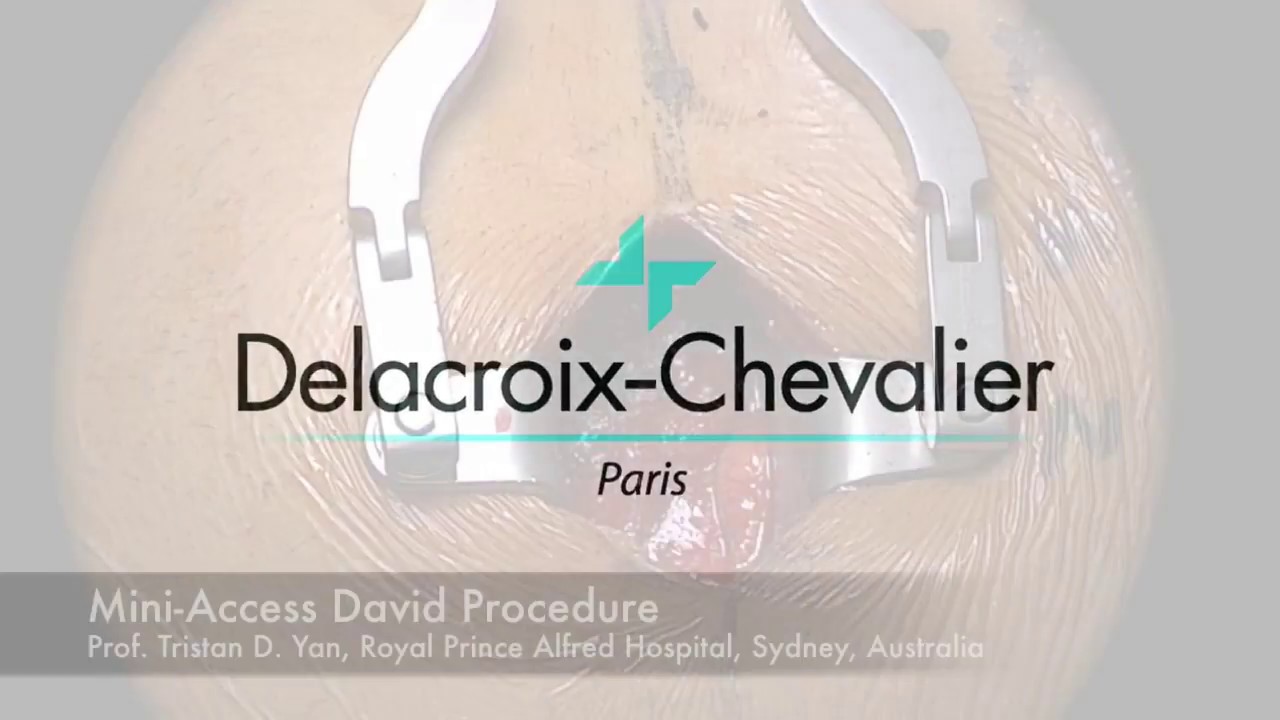 Mini-Access David Procedure - YouTube