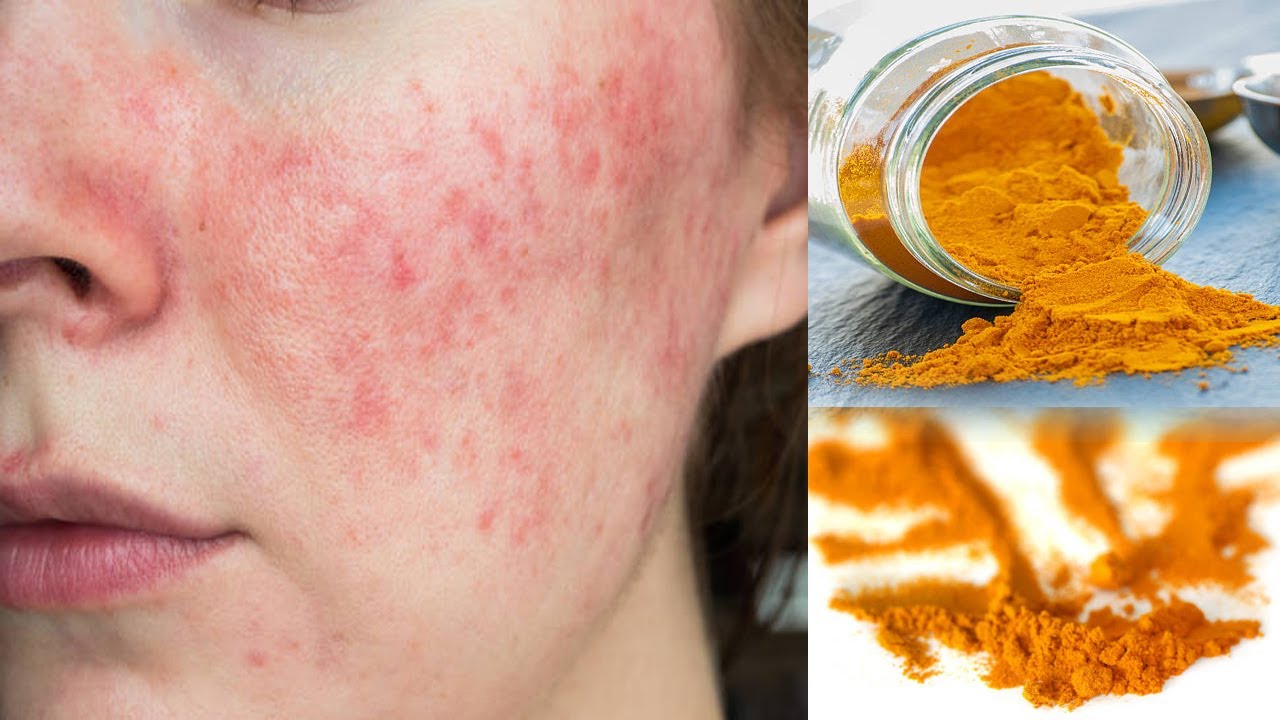 Turmeric Benefits Pinch Of Turmeric Use Turmeric as Medicine & Side ...