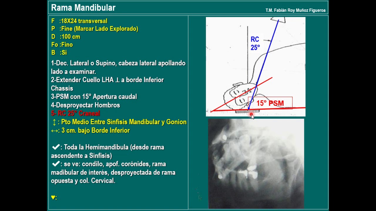 Cabeza en RX 06 Mandíbula - YouTube