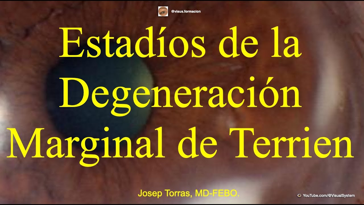 Estadíos de la Degeneración Marginal de Terrien. - YouTube