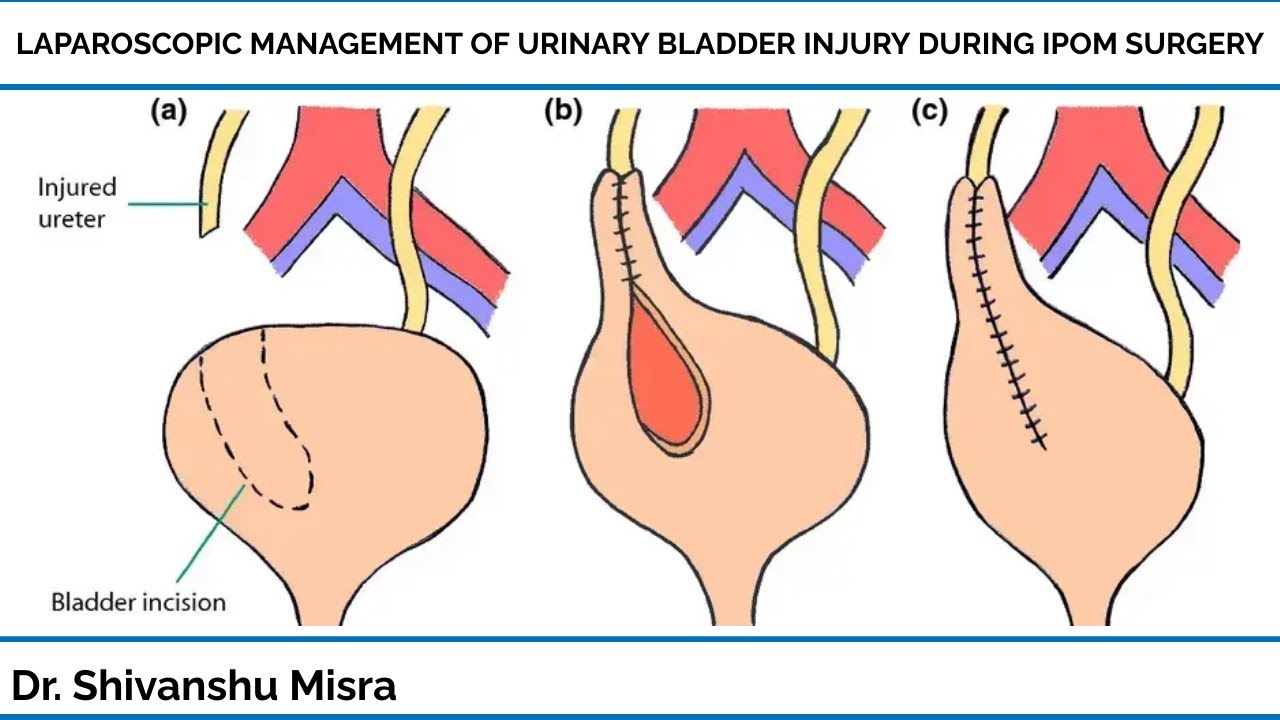 LAPAROSCOPIC MANAGEMENT OF URINARY BLADDER INJURY DURING IPOM SURGERY ...