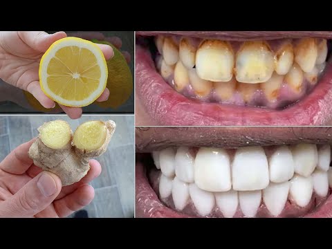 Sadece 1 dakika içinde diş beyazlatma - sararan ve biriken tartarları süt gibi beyaz ve parlak olsun