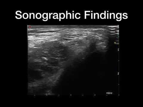 Adding an Ultrasound Scan Before the Injection Reveals a Rare Cause of ...
