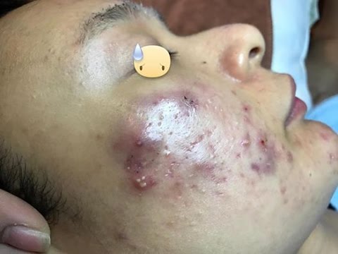 BLACKHEAD - Treatment of acne, blackheads, pimple - blackheads on the ...