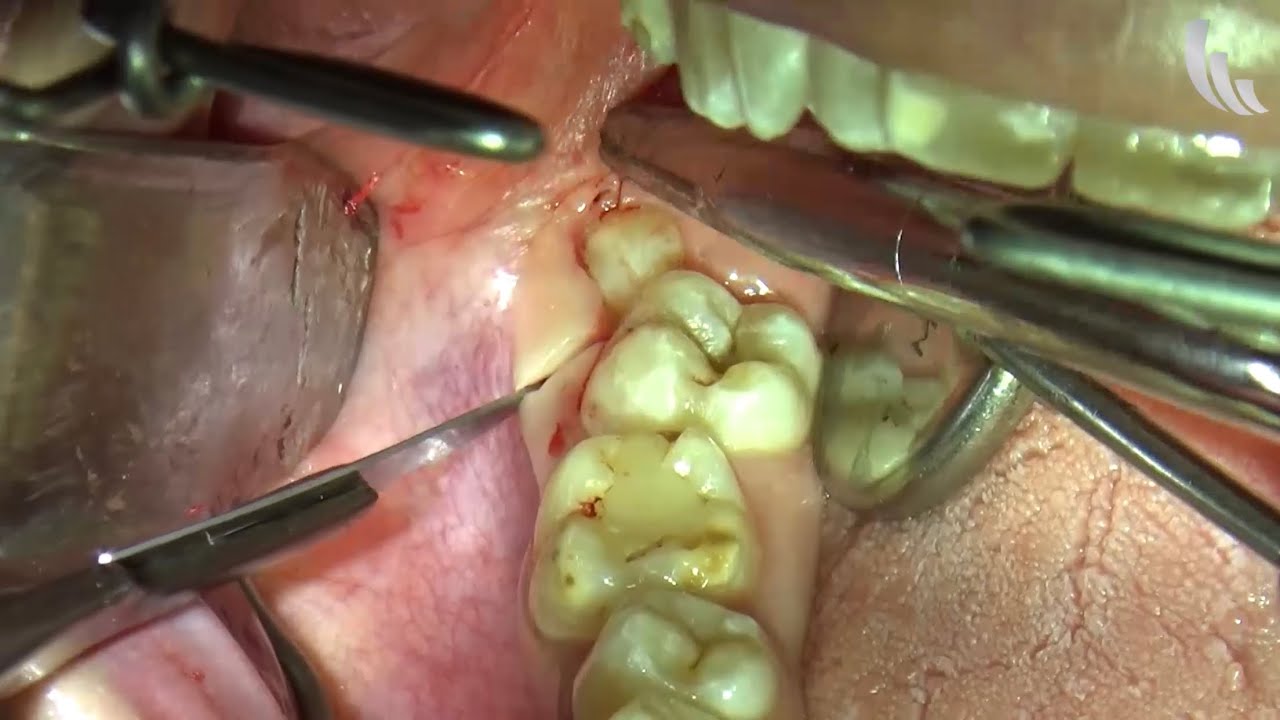 Cid Exodontia Terceiro Molar - RETOEDU