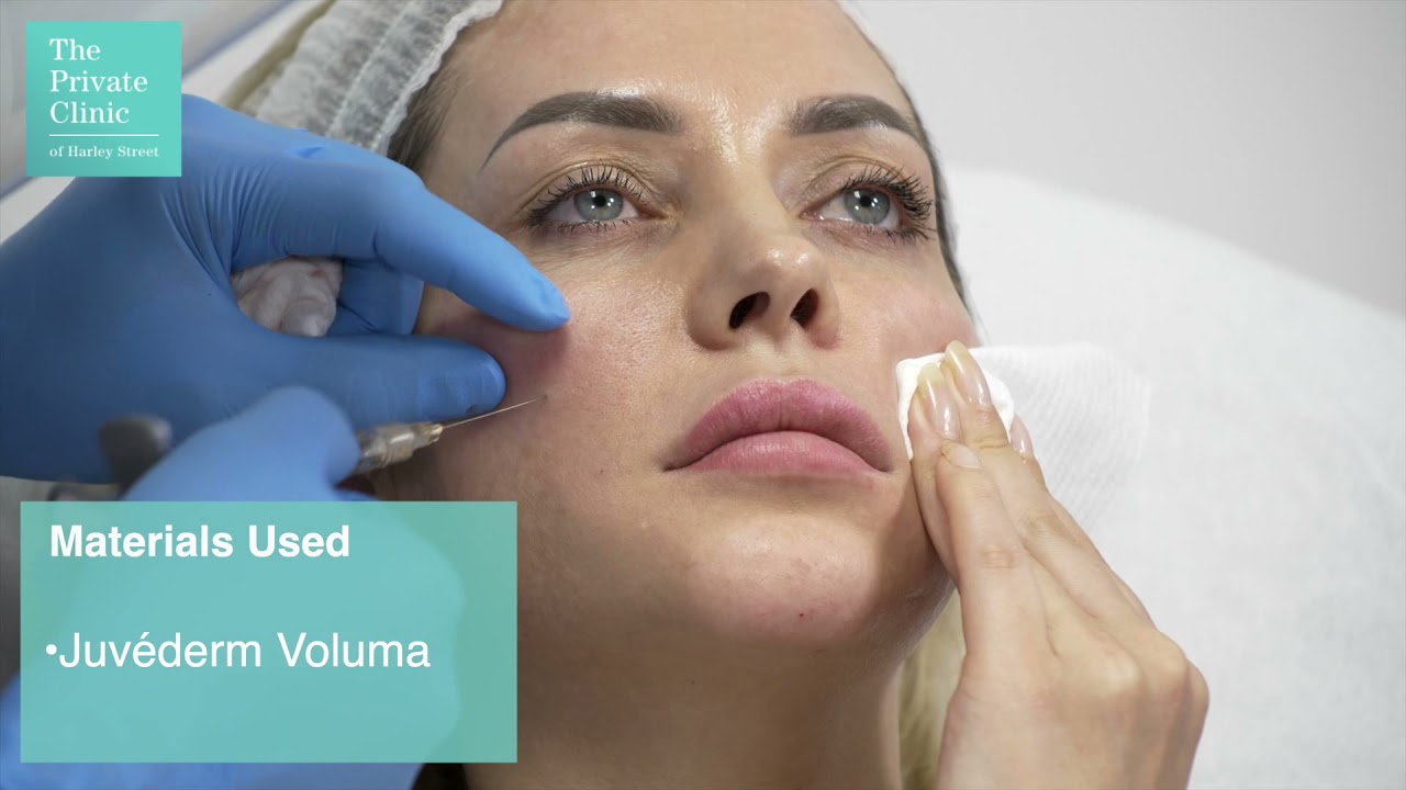 Smile Line Filler, Facial Fillers for Laugh Lines, Contouring Cheek and ...