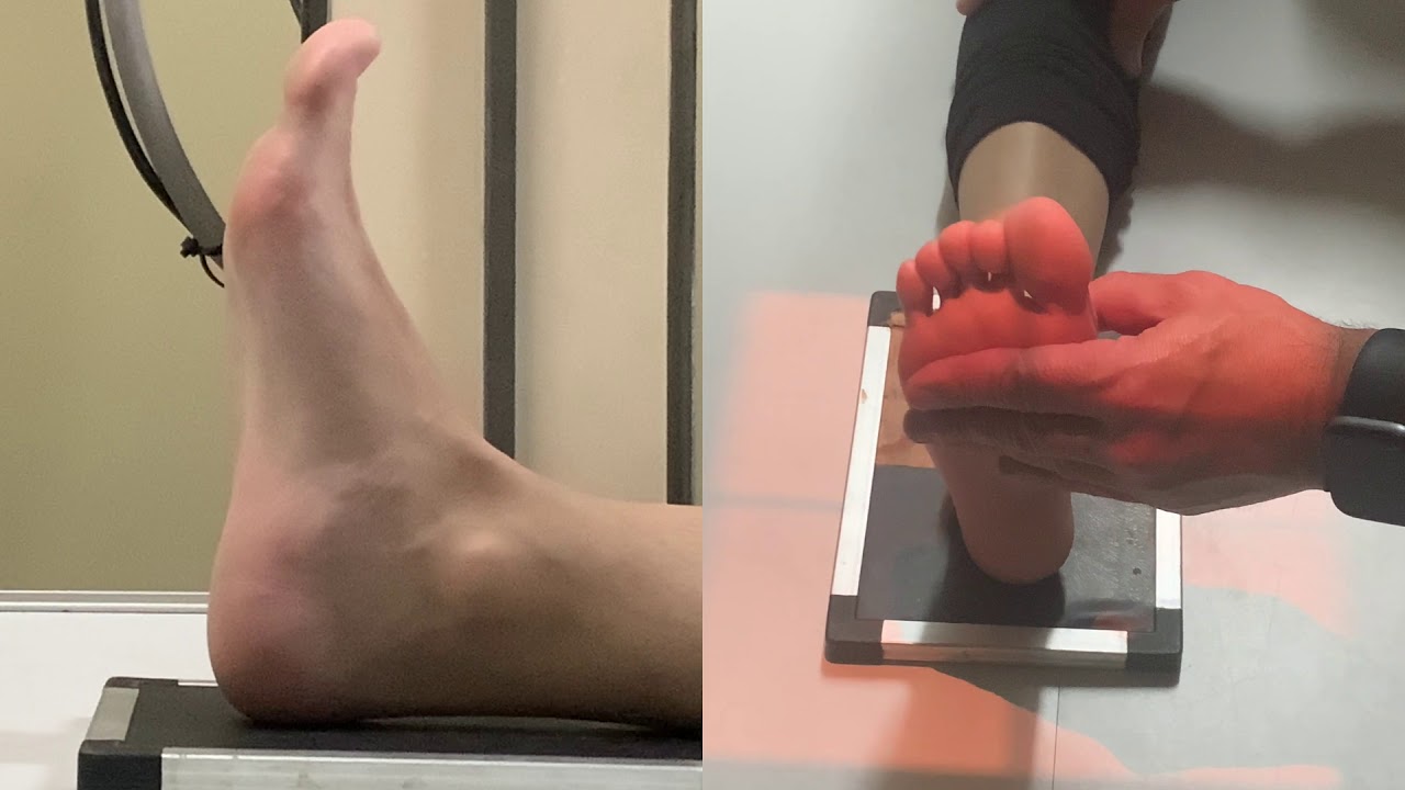 RX TOBILLO FRENTE, PERFIL Y AXIAL DE CALCÁNEO EN PACIENTE AMBULATORIO ...