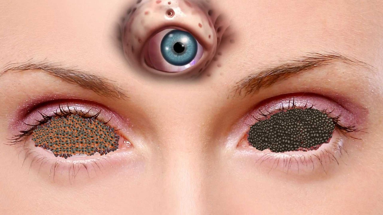 ASMR Animation treatment from infected Eye | Dog Ticks and Maggot Infected Eye - YouTube