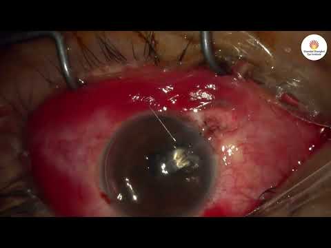 Corneo-Scleral Tear Repair | A Surgical Case by Dr. Prajakta Dandekar