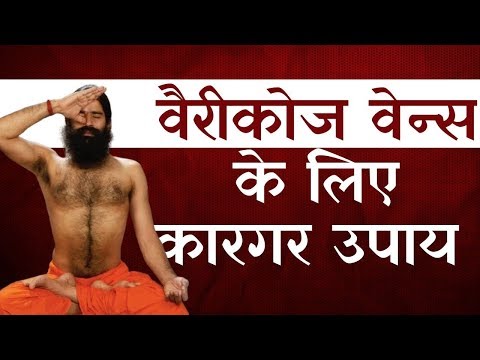 वैरीकोज वेन्स से पाना है छुटकारा, स्वामी रामदेव से जानें कारगर उपाय