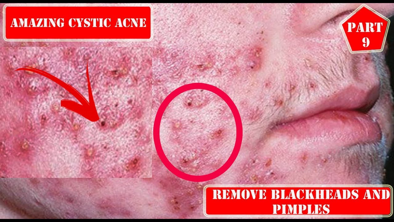 Cystic Acne, Pimples And Blackheads Extraction Acne Treatment On Face ...