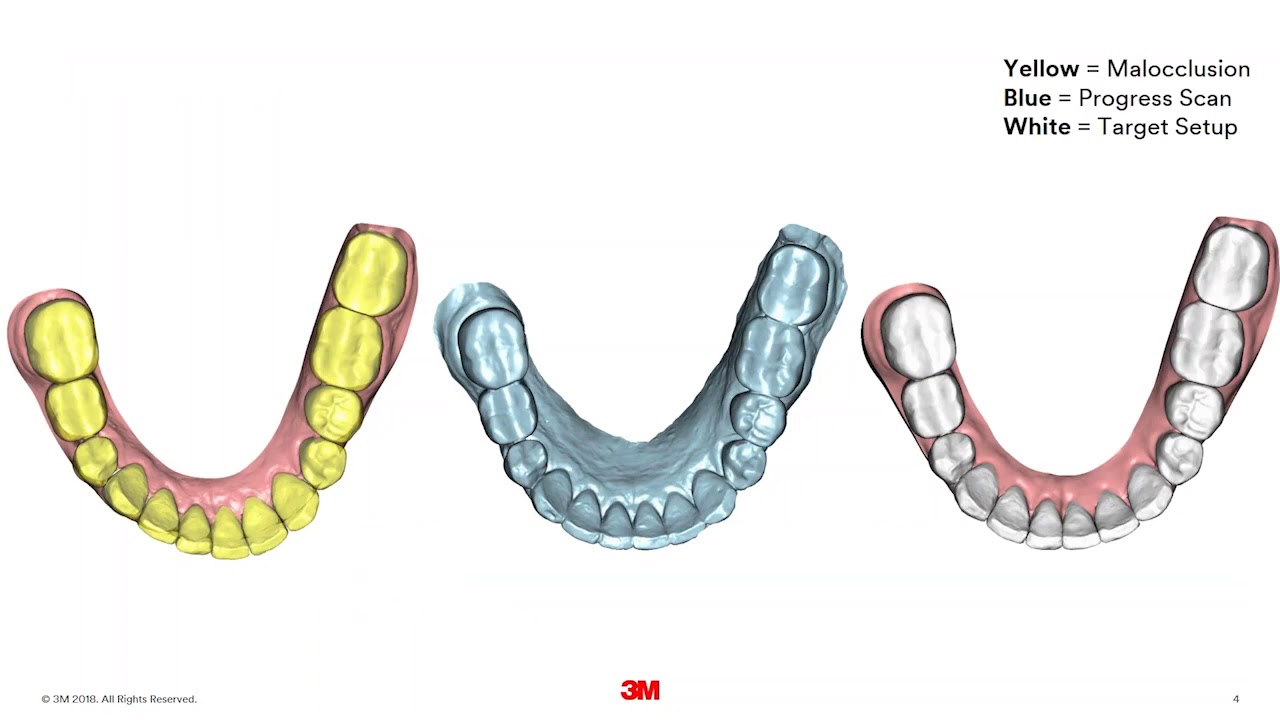 3M™ Clarity™ Aligners Case Study Dr. Hughes - YouTube