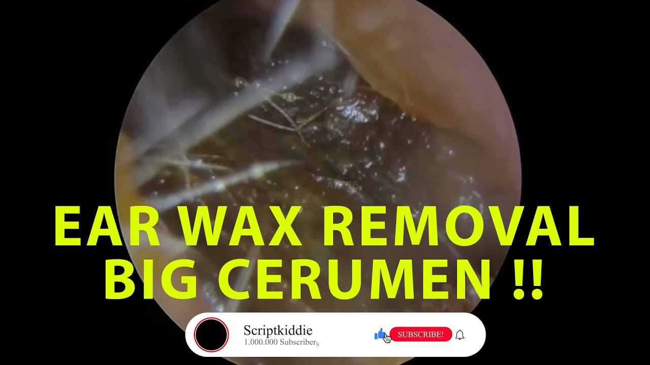 ASMR EAR WAX REMOVAL !! BIG CERUMEN - YouTube