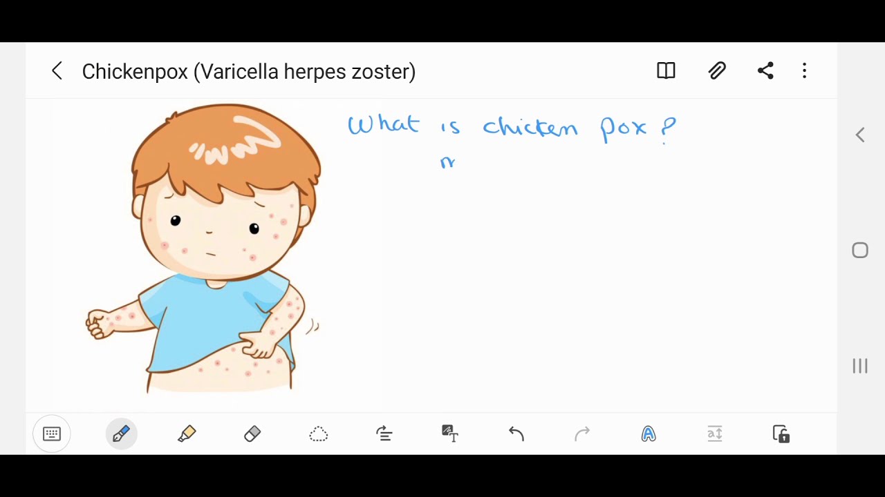 Chickenpox (Varicella herpes zoster): Definition, symptoms, signs ...
