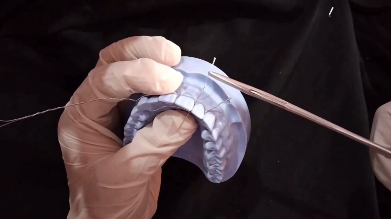 Teknik Splinting Essig's Wiring & Teknik Col Stout's Multiloop Wiring ...