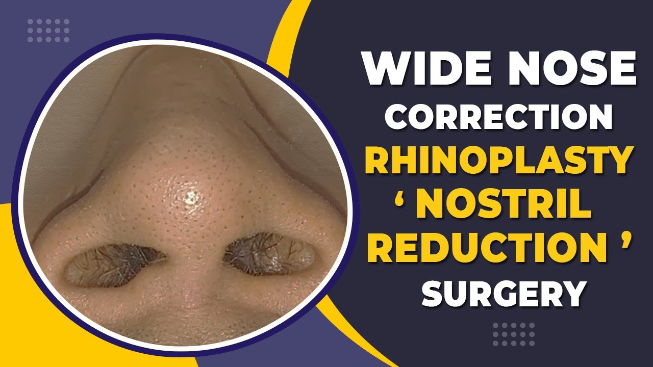 Wide Nose Correction Rhinoplasty Procedure | Nostril Reduction Surgery ...