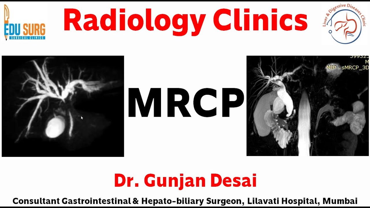 MRCP simplified: Gall bladder and bile duct anatomy on MRI - YouTube