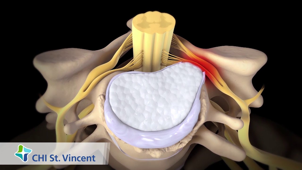 Anterior Cervical Discectomy and Fusion - YouTube