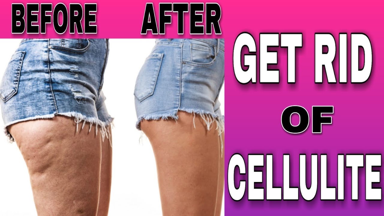 HOW TO GET RID OF CELLULITE VERY FAST AT HOME|VIANA'S BEAUTY - YouTube