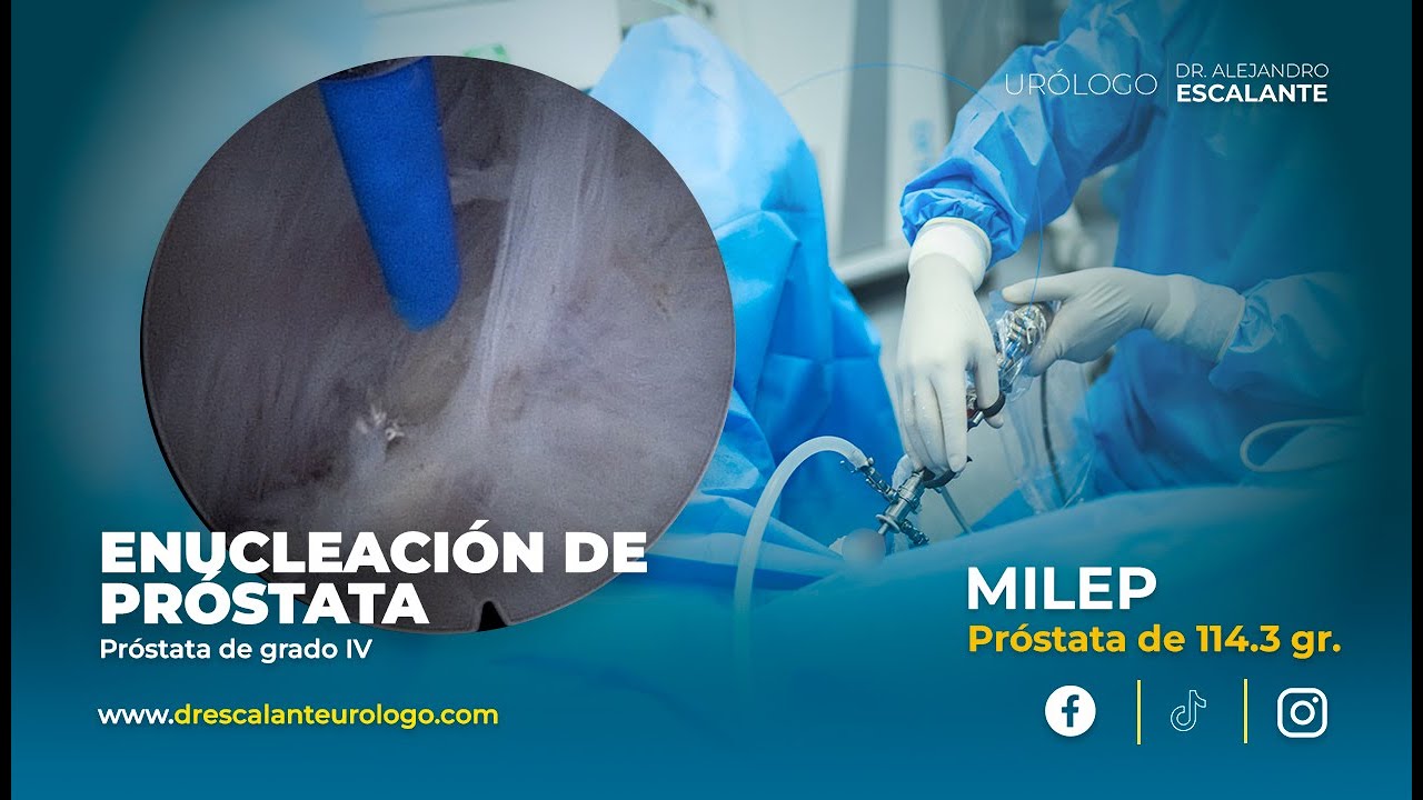 Enucleación endoscópica de próstata - MiLEP | Próstata de 114.3 Gr. con ...