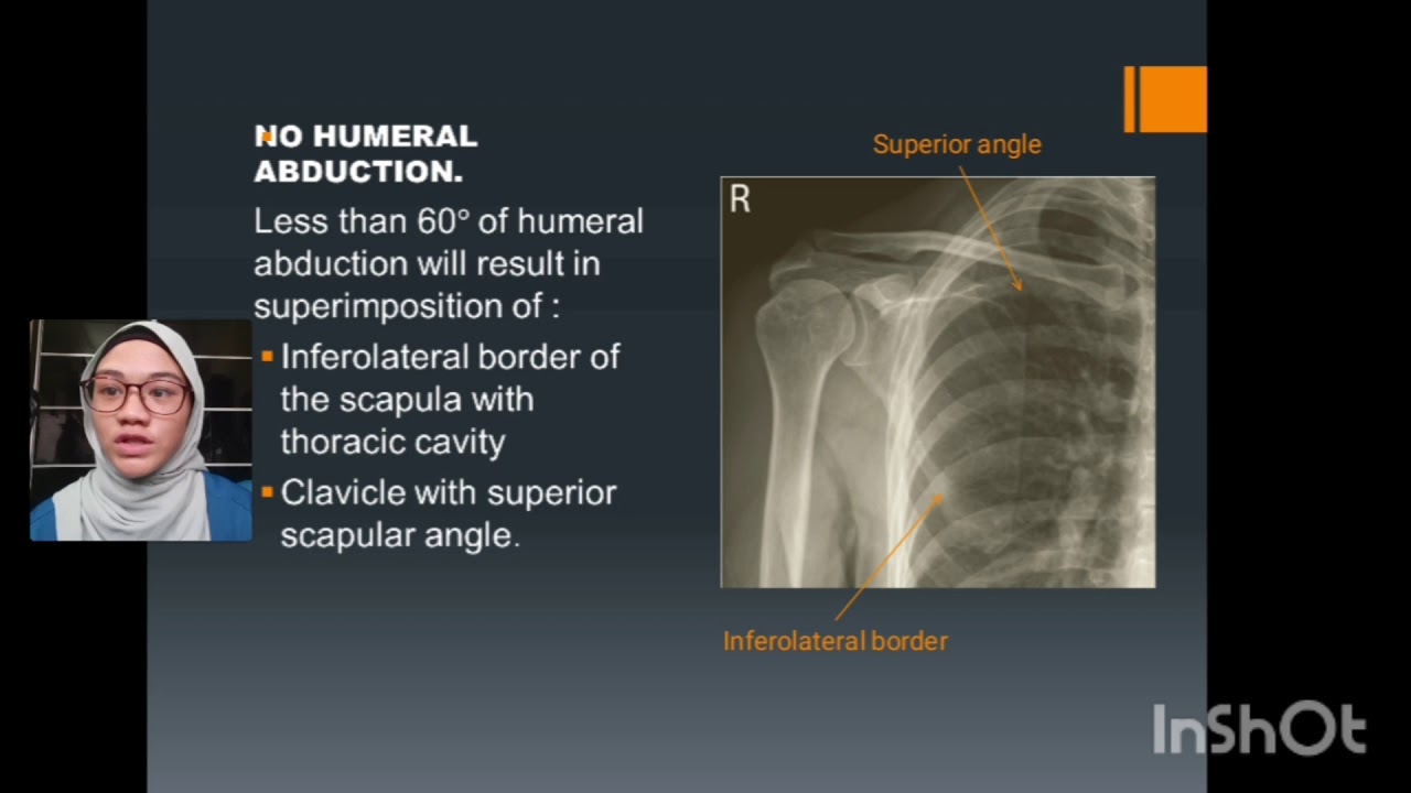 RADIOGRAPHIC IMAGE EVALUATION OF AP SCAPULA - YouTube