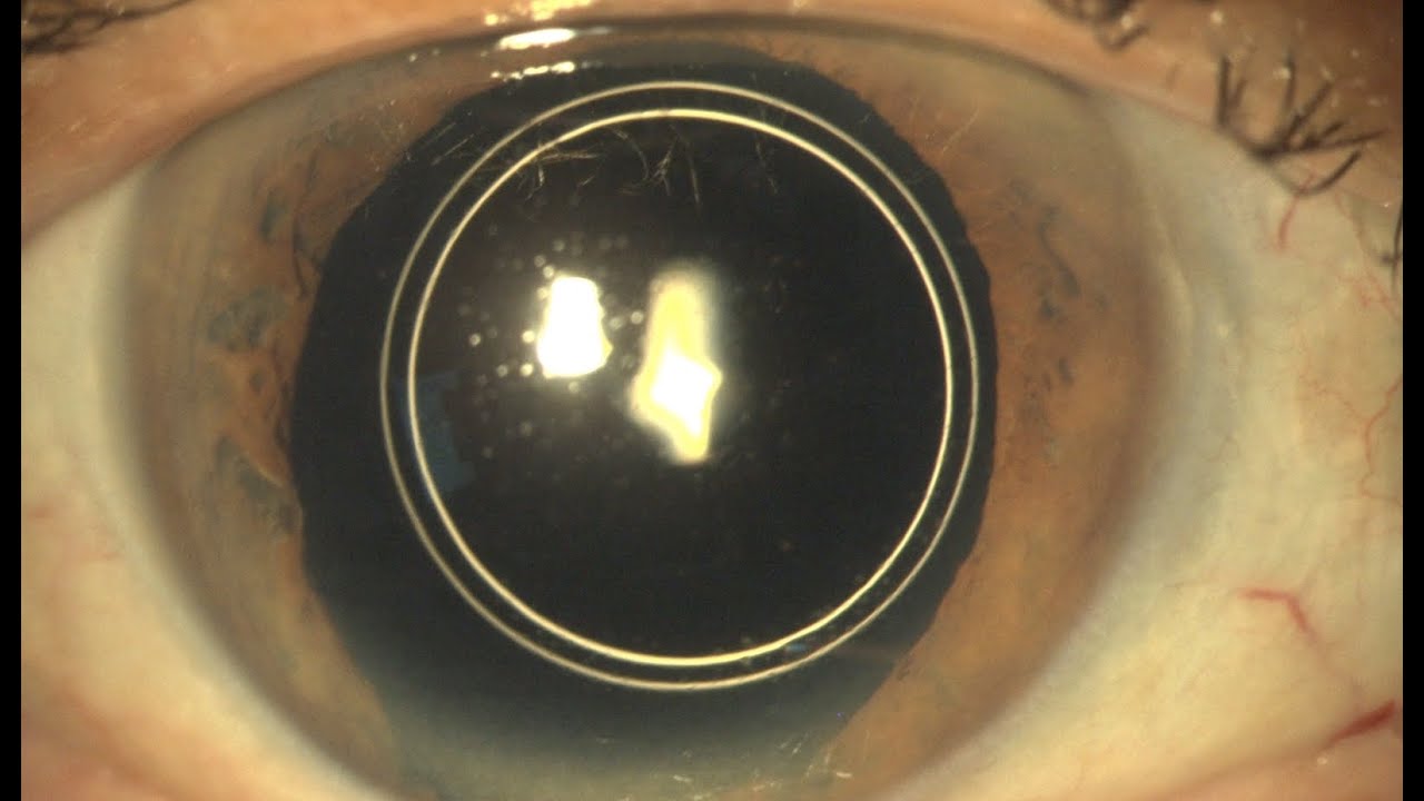 Iris cerclage and Yamane scleral fixation for post traumatic lens ...