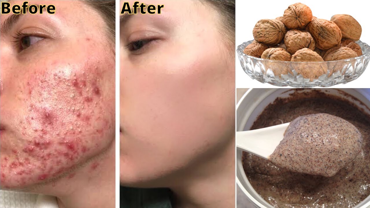 Treat Pimples, Dark Spots & Skin Pigmentation with Walnut अखरोट से हटाए ...