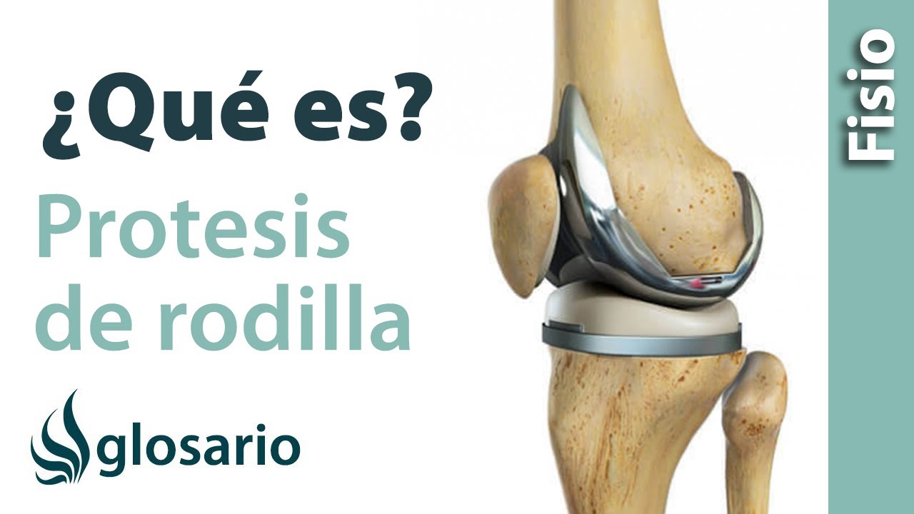 PRÓTESIS DE RODILLA | ¿Qué es? - YouTube
