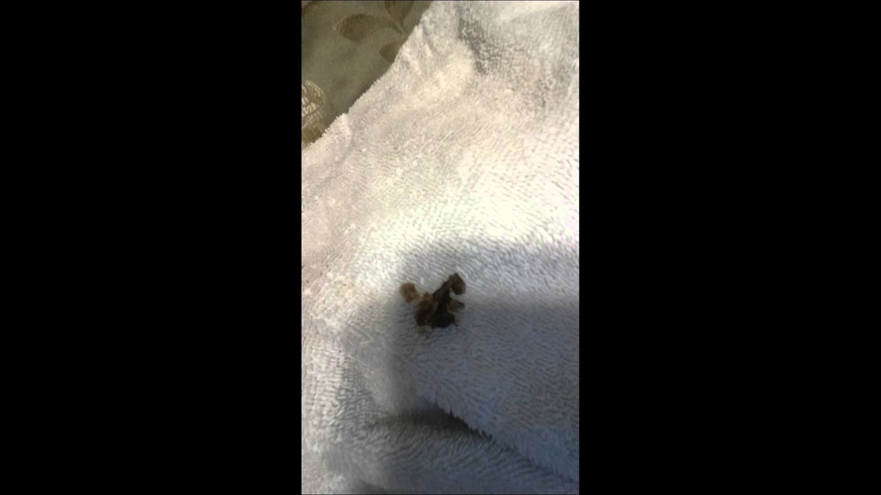 Nasty ear wax removal - YouTube